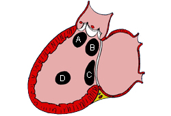 Congenital heart disease - Medical information | BMJ Best Practice