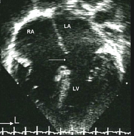Congenital heart disease - Details | BMJ Best Practice US
