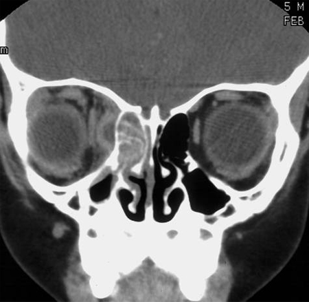 Acute sinusitis - Diagnosis Approach | BMJ Best Practice