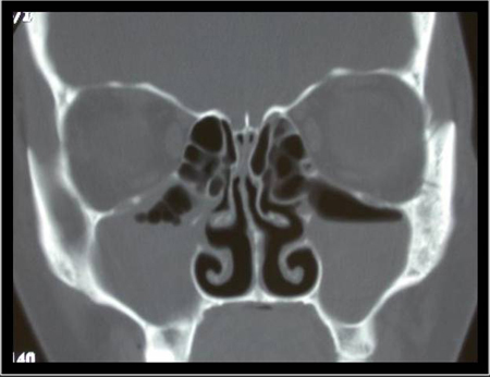 Acute sinusitis - Investigations | BMJ Best Practice