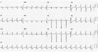 Unstable angina - Investigations | BMJ Best Practice US