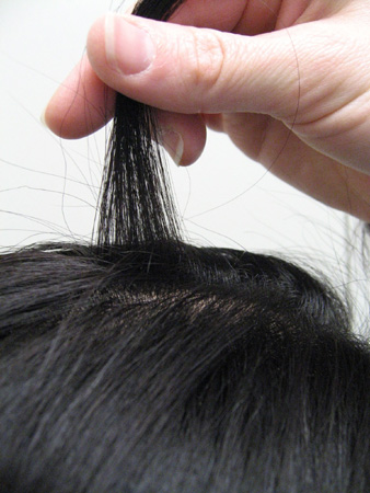 Androgenetic alopecia - Case history | BMJ Best Practice US