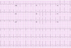 New-onset atrial fibrillation - Symptoms, diagnosis and treatment | BMJ ...