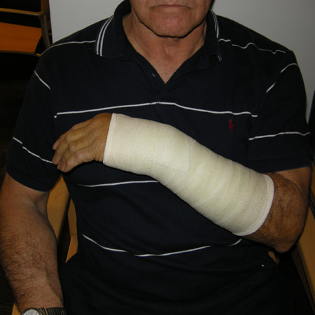 Wrist fractures - Management recommendations | BMJ Best Practice