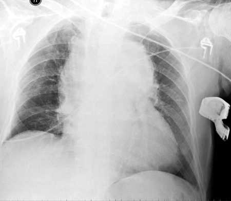 Assessment of chest pain - Differentials | BMJ Best Practice