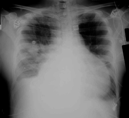 Assessment of chest pain - Differentials | BMJ Best Practice