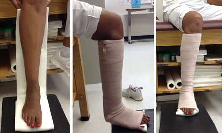 Long bone fracture - Treatment algorithm | BMJ Best Practice US