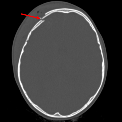 Skull fractures - Symptoms, diagnosis and treatment | BMJ Best Practice