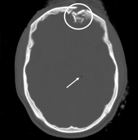 Skull fractures - Symptoms, diagnosis and treatment | BMJ Best Practice