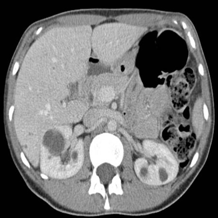 Polycystic kidney disease - Investigations | BMJ Best Practice US