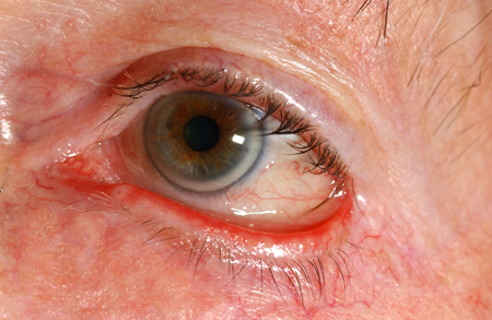 Evaluation of red eye - Differentials | BMJ Best Practice US