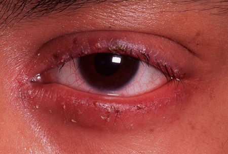 Evaluation of red eye - Differentials | BMJ Best Practice US