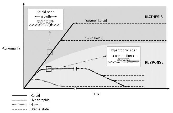 Keloid - Aetiology | BMJ Best Practice