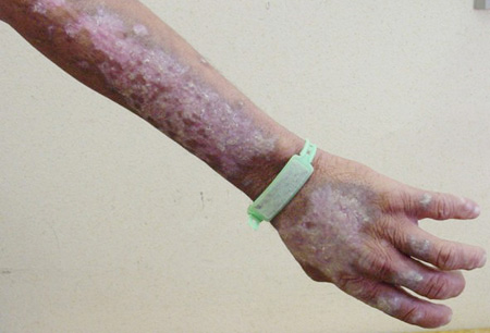 Vitamin B3 deficiency - Symptoms, diagnosis and treatment | BMJ Best ...