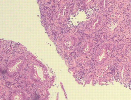 Evaluation of proctitis - Differentials | BMJ Best Practice US