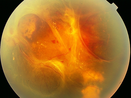 Retinal detachment - Diagnosis Approach | BMJ Best Practice US