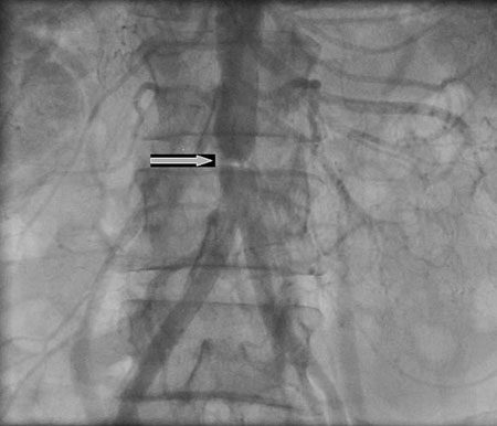 Aortic coarctation - Etiology | BMJ Best Practice US