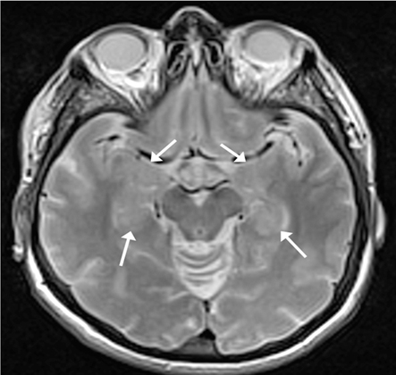 Evaluation of memory deficit - Differentials | BMJ Best Practice US