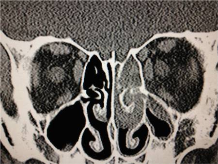 Peri-orbital and orbital cellulitis - Investigations | BMJ Best Practice