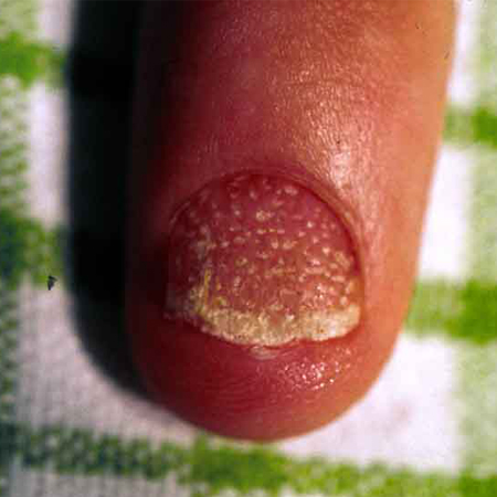 Psoriasis - History and exam | BMJ Best Practice US