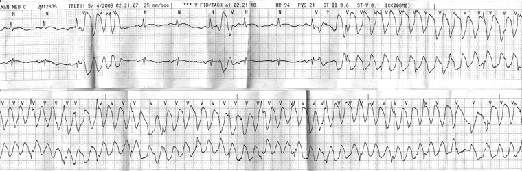 Assessment of tachycardia - Diagnosis Approach | BMJ Best Practice