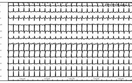 Evaluation of tachycardia - Etiology | BMJ Best Practice US