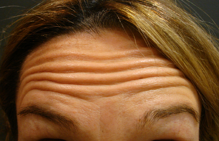 Wrinkles - History and exam | BMJ Best Practice US