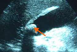 Cholelithiasis (Gallstones) - Symptoms, diagnosis and treatment | BMJ ...