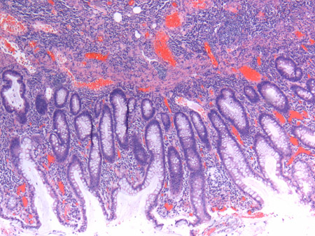 Toxic colitis and toxic megacolon - Investigations | BMJ Best Practice
