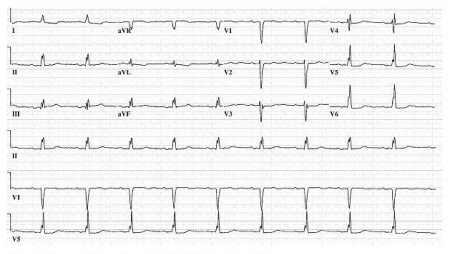 Assessment of splenomegaly - Diagnosis Approach | BMJ Best Practice