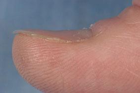 Iron deficiency anemia - History and exam | BMJ Best Practice US