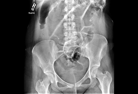 Small bowel obstruction - Symptoms, diagnosis and treatment | BMJ Best ...