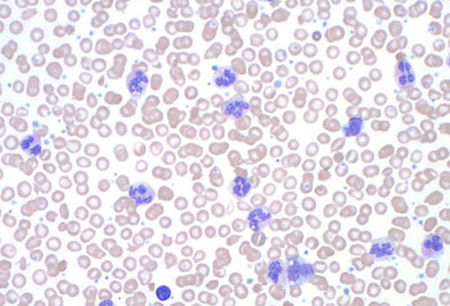 Assessment of neutrophilia - Differential diagnosis of symptoms | BMJ ...