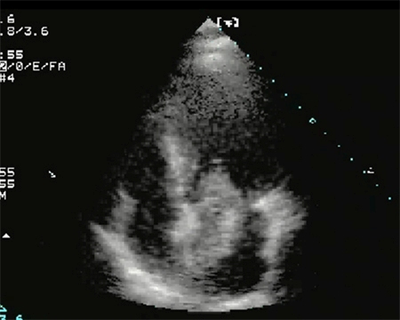 Mixoma atrial - Sintomas, diagnóstico e tratamento | BMJ Best Practice