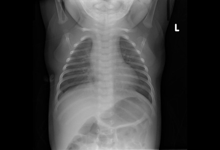 Respiratory syncytial virus infection - Symptoms, diagnosis and ...