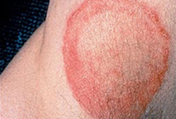 Infecciones por dermatofitos - Síntomas, diagnóstico y tratamiento ...