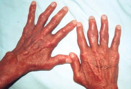 Gota - Sintomas, diagnóstico e tratamento | BMJ Best Practice