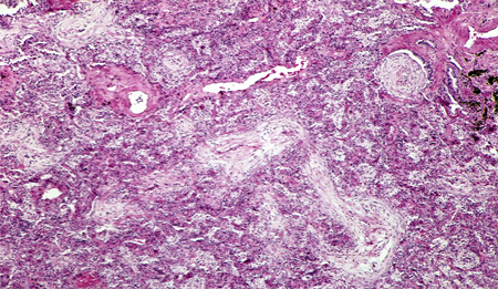 Bronchiolitis obliterans organizing pneumonia - Symptoms, diagnosis and ...