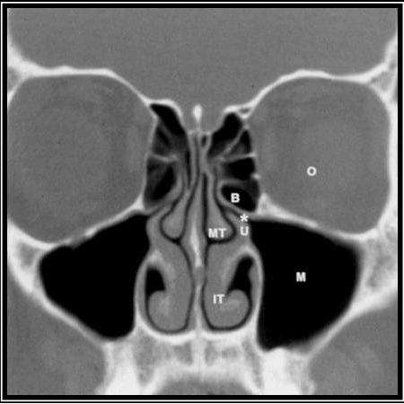 Acute sinusitis - Investigations | BMJ Best Practice