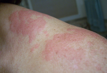 Evaluation of urticaria - Differential diagnosis of symptoms | BMJ Best ...