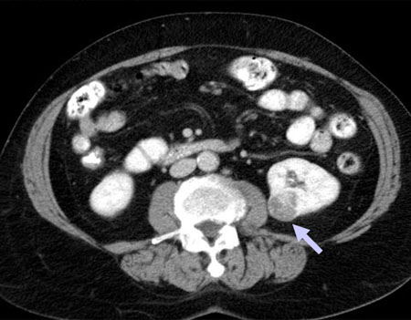 What Does Kidney Cancer Look Like On Ct Scan Ct Scan Machine