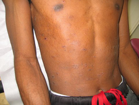 My Pityriasis Rosea Blog I Have Pityriasis Rosea