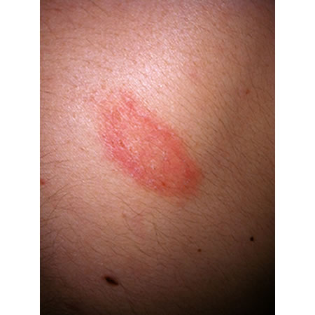 Pitiríase rósea - Symptoms, diagnosis and treatment | BMJ Best Practice