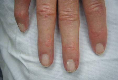 Systemic sclerosis (scleroderma) - Symptoms, diagnosis and treatment ...
