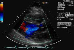 Aortic regurgitation - Symptoms, diagnosis and treatment | BMJ Best ...