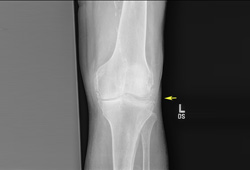 Calcium pyrophosphate deposition - Symptoms, diagnosis and treatment ...