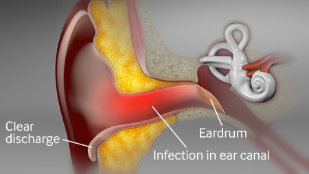 Bacterial Otitis Externa