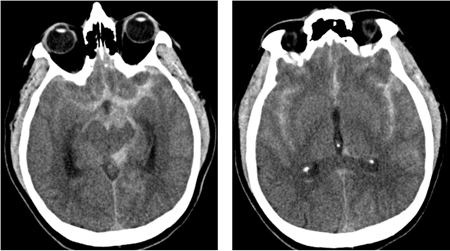 Hemorragia subaracnoide - Symptoms, diagnosis and treatment | BMJ Best ...