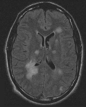 Encephalitis Mri