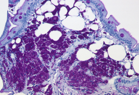 Whipple disease - Symptoms, diagnosis and treatment | BMJ Best Practice US